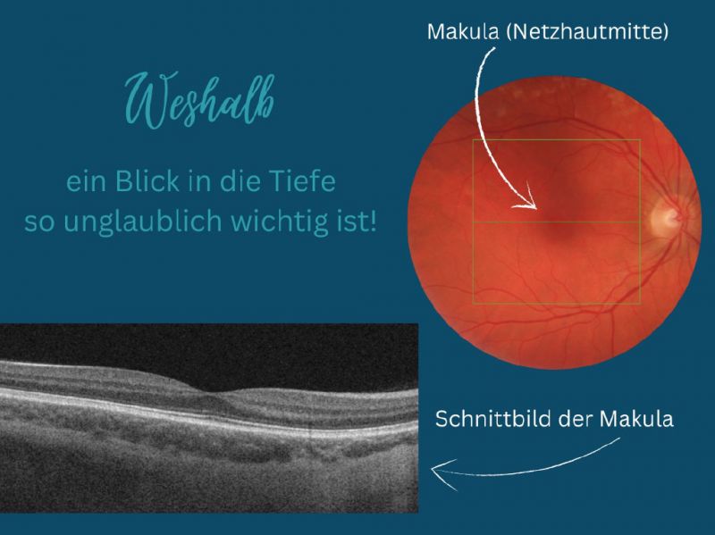 Die Makula – dargestellt in der optischen Cohärenztomographie (OCT ...